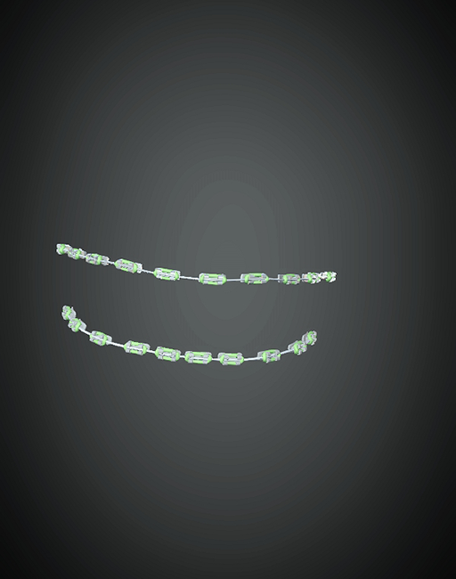 Braces Again